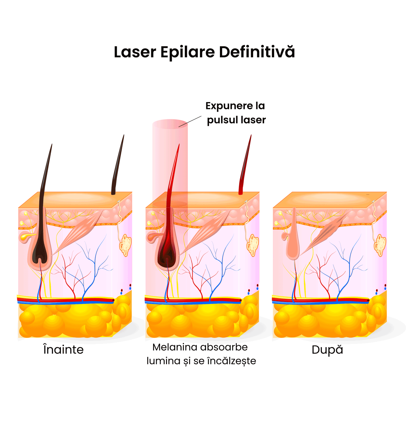 Acasa - Epilare definitiva constanta | Ultima Generatie | Epilare Laser ...